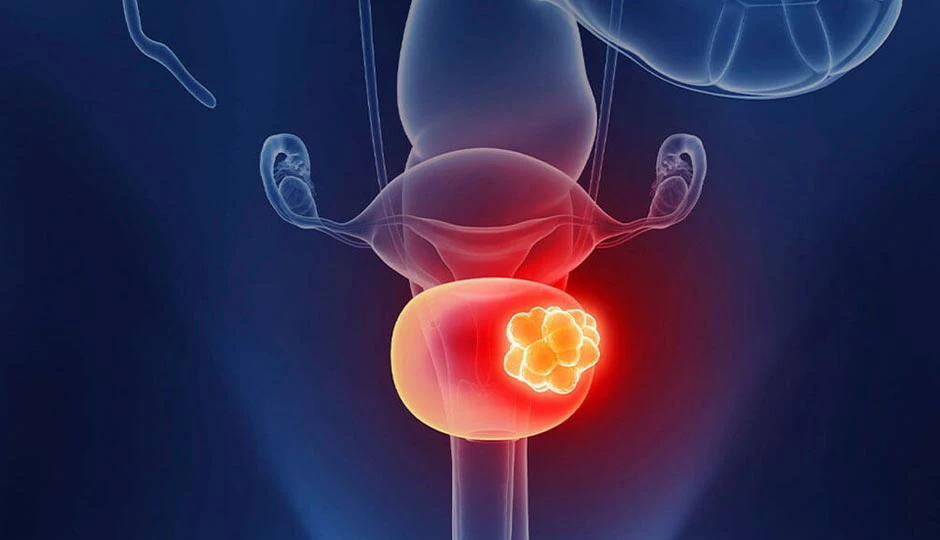 7 Ways To Treat Urinary Bladder Cancer | Dailyhunt