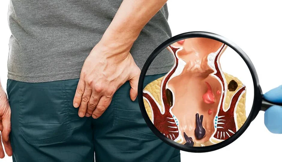 8 Home Remedies To Treat Piles | Dailyhunt