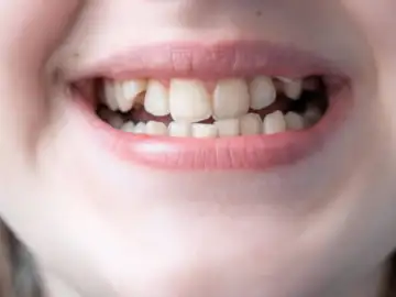 Parenting Tips: If your child is also developing crooked teeth, keep ...