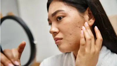 Does Niacinamide Cause Purging? Dermatologist Insights | Dailyhunt