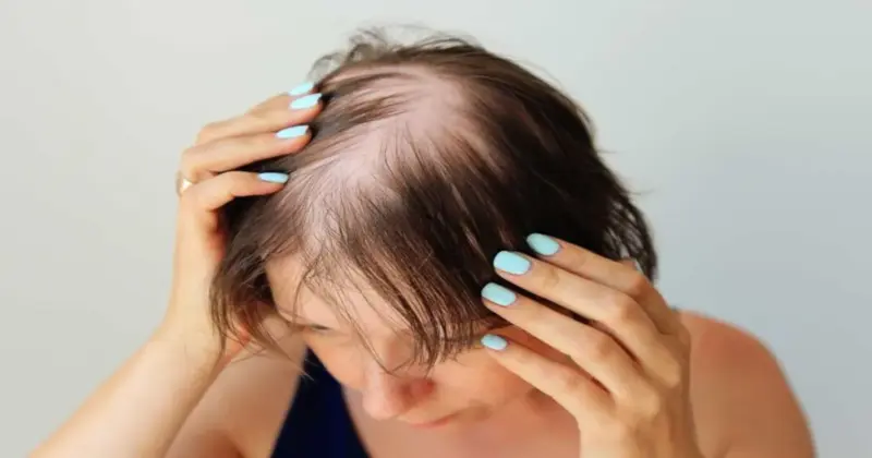 Trichologist Explains Difference Between Stress Shedding And Hormonal ...