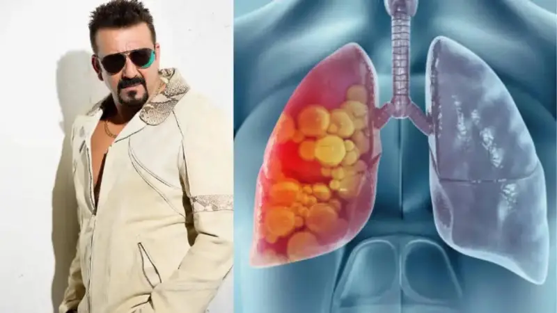 Sanjay Dutt's Health Journey: The Importance of Regular Check-Ups Post ...
