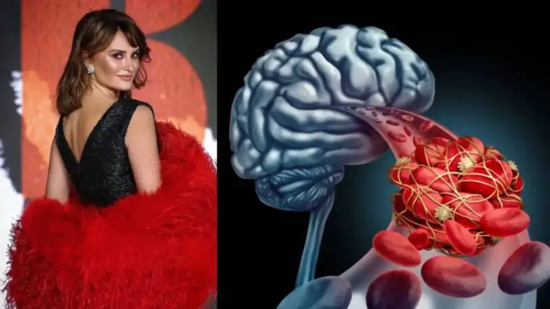 Penelope Cruz's Health Scare Highlights Brain Aneurysm Awareness ...