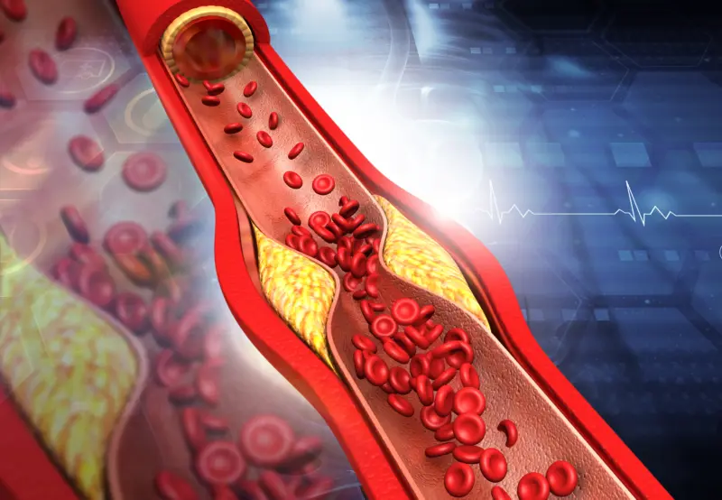One-time gene therapy may lower up to 62% 'bad' cholesterol, clinical ...