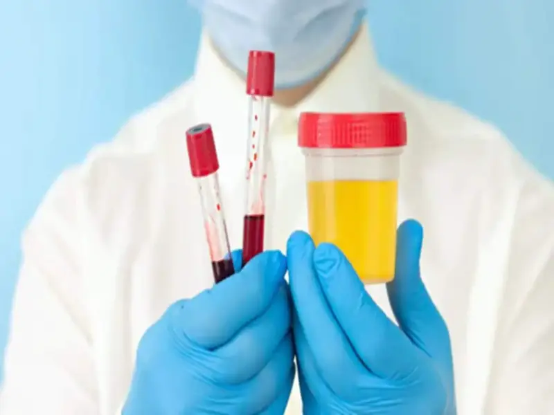 The Importance of Urine Tests in Health Diagnostics | Dailyhunt